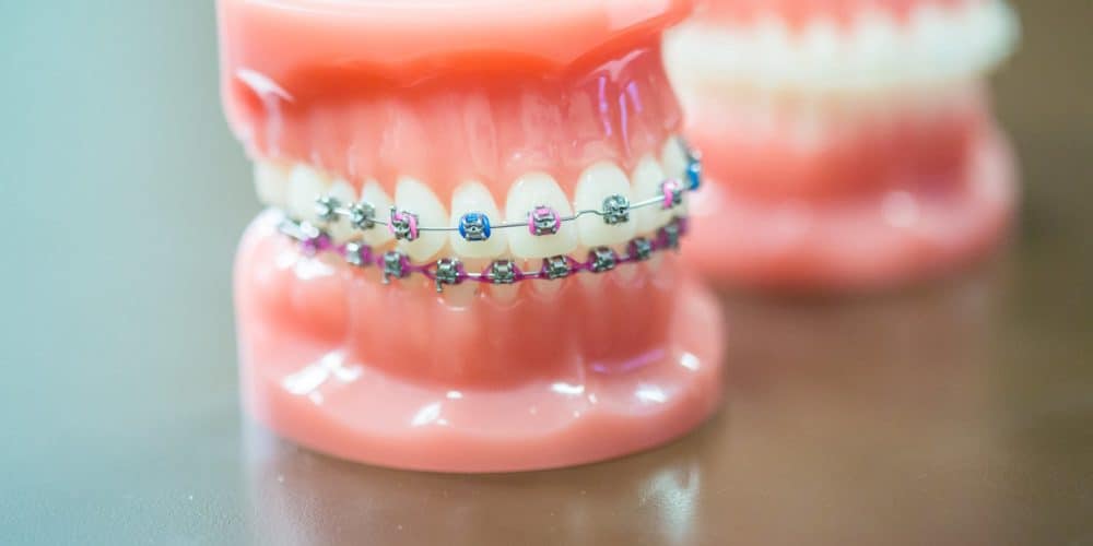 Braces - Adults & Teens - Jonesboro, AR Fergus Orthodontics
